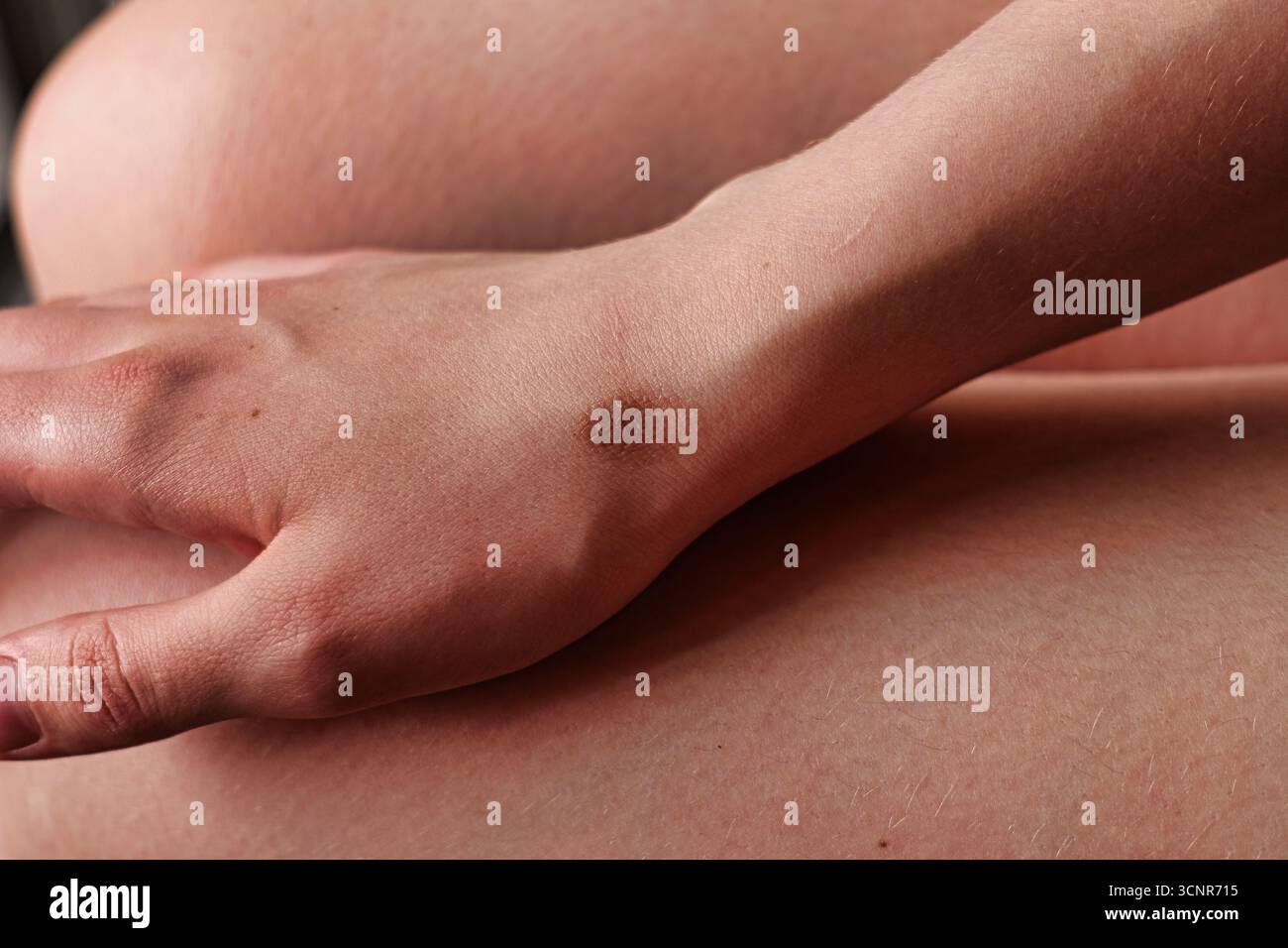 Nevus formation hi-res stock photography and images - Alamy