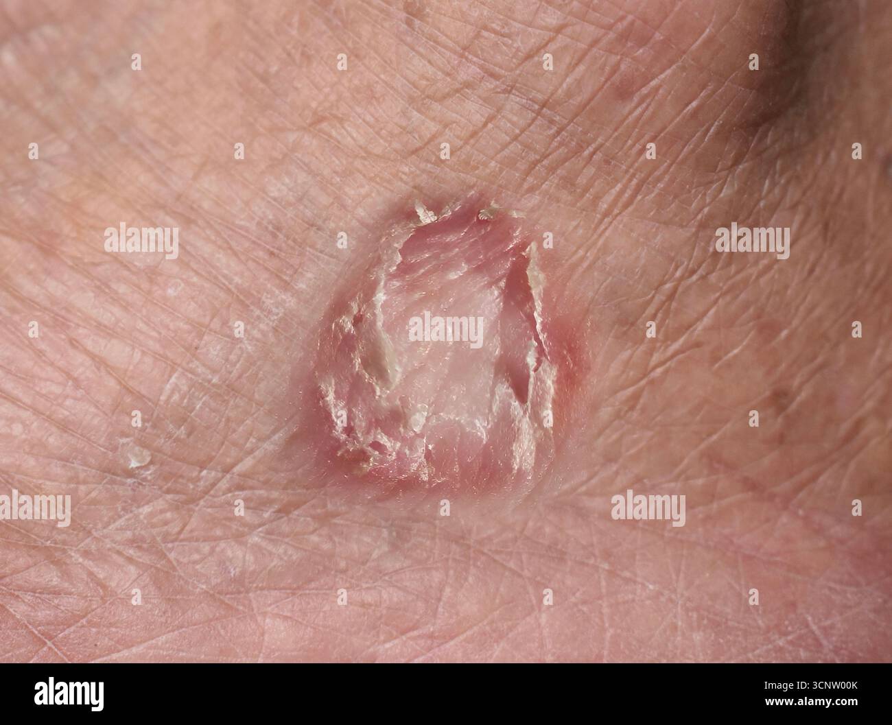 White flaky ringworm infection on skin with a red border Stock Photo ...