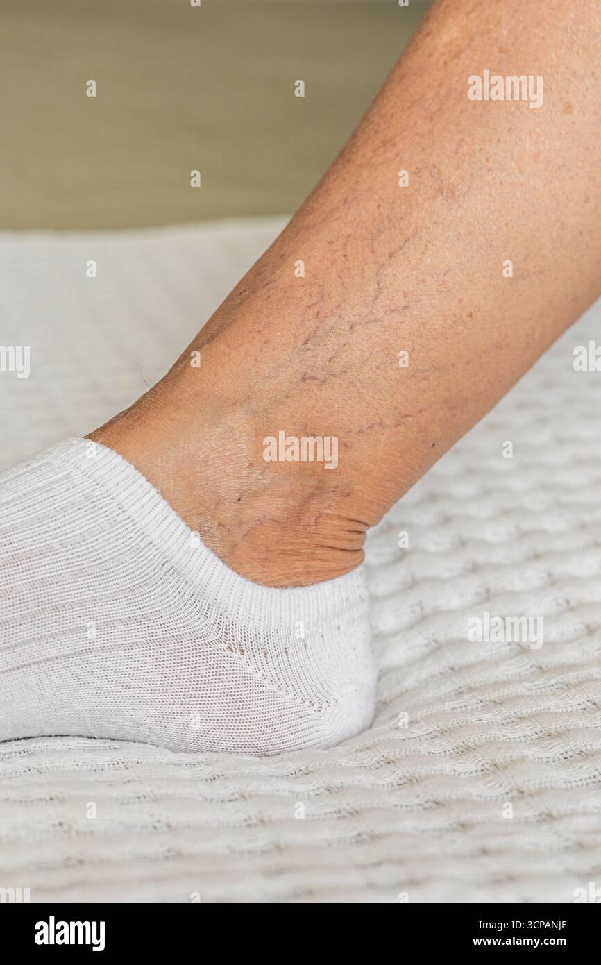 Close-up of a leg showing varicose veins and capillaries. The person ...