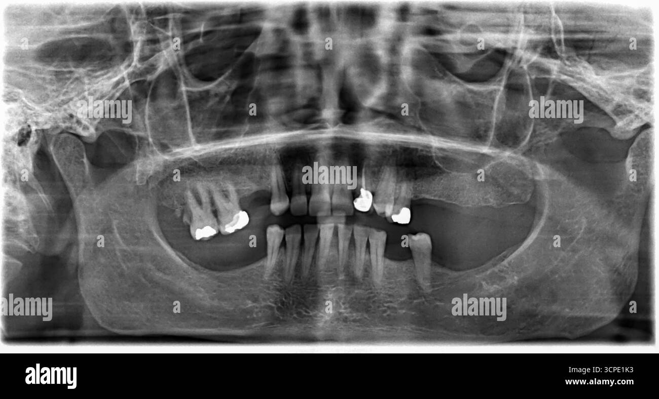Panoramic dental x ray Cut Out Stock Images & Pictures - Alamy