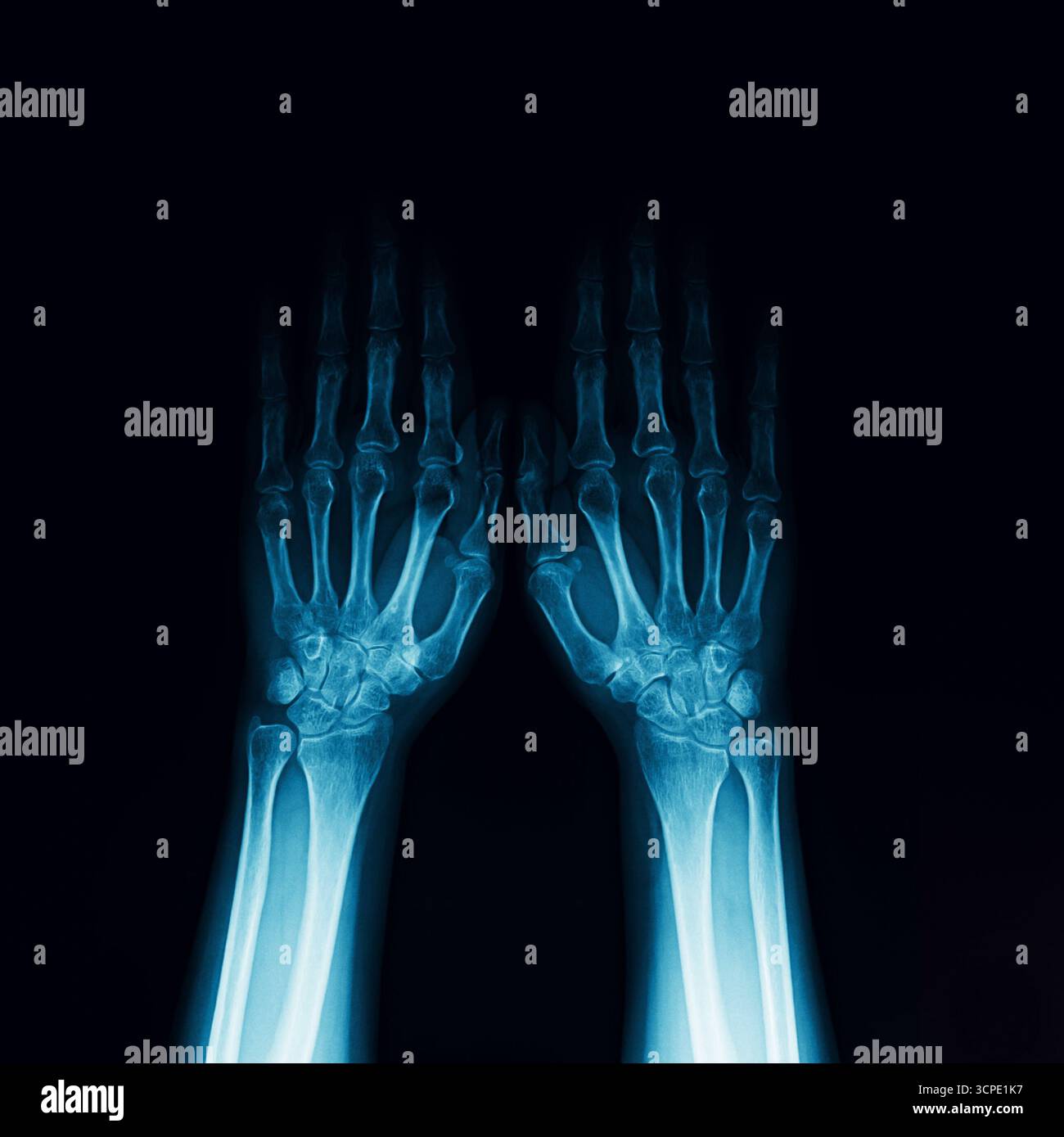 Symmetrical X-ray radiograph of two human wrists and hands with ...