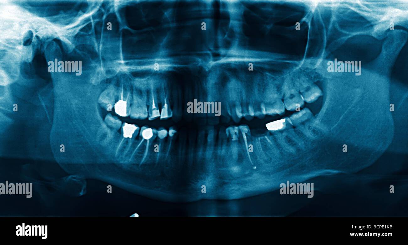 Panoramic dental X-ray radiograph image showing the entire mouth and ...