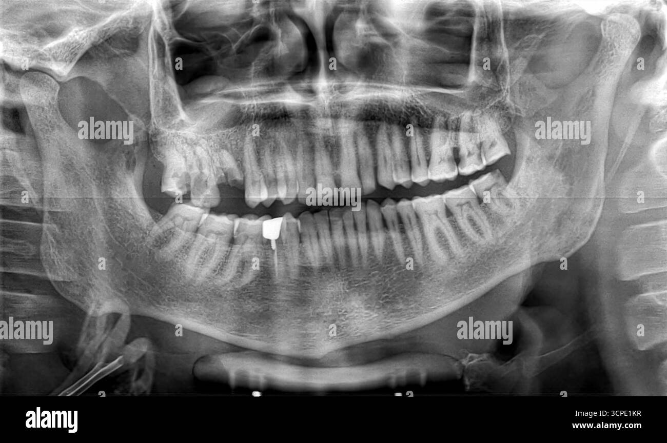 Filling showing Black and White Stock Photos & Images - Alamy