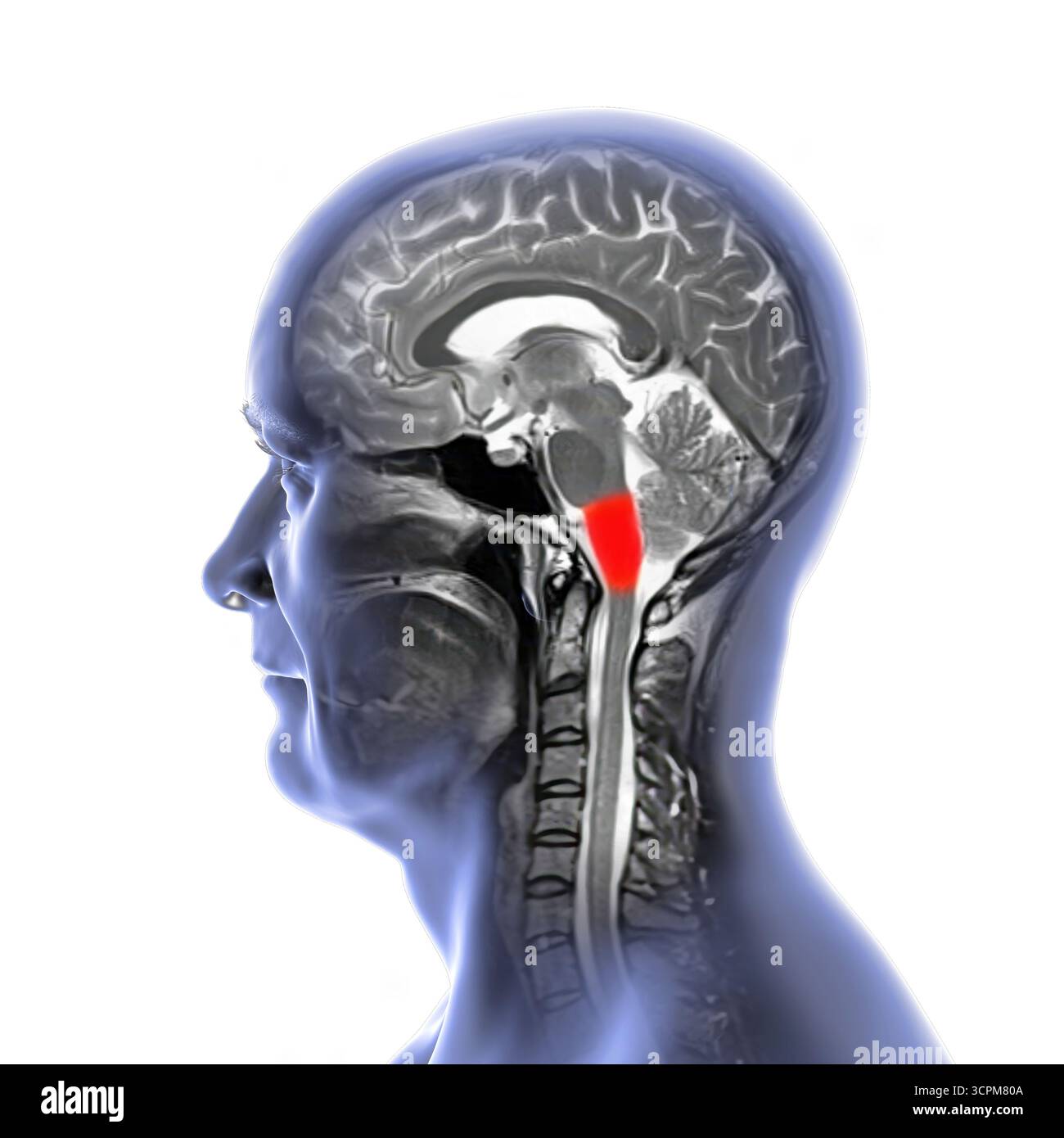 Illustration of a coloured magnetic resonance imaging (MRI) scan of the ...