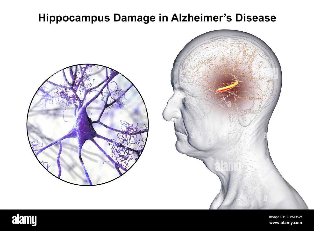 Illustration of Alzheimer's disease, showing hippocampus degeneration ...