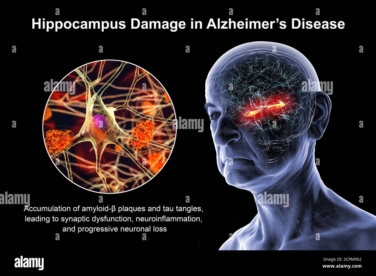 Illustration of Alzheimer's disease, showing hippocampus degeneration ...