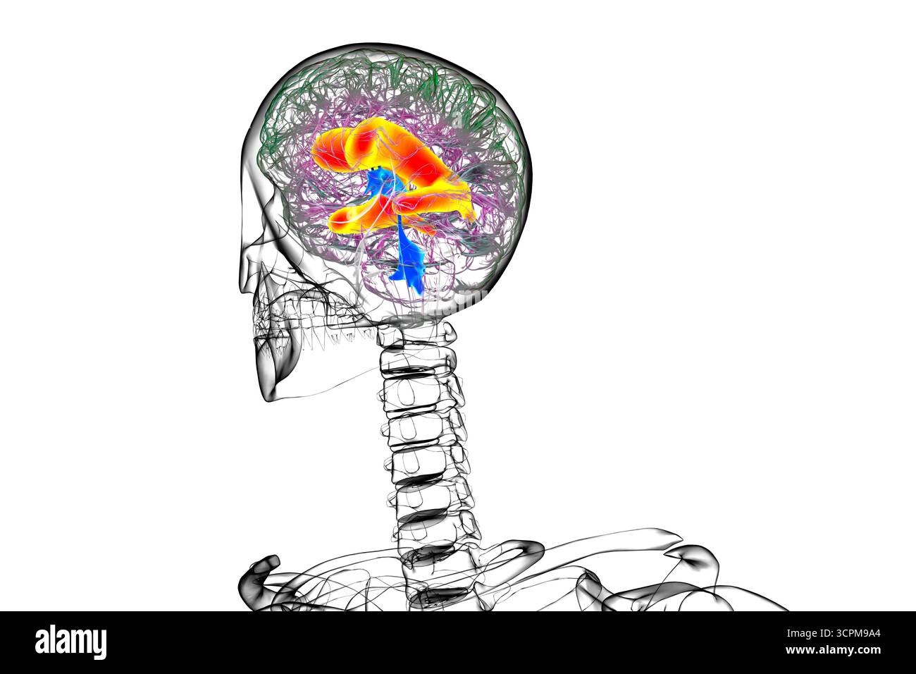 Enlarged lateral ventricles of the brain (hydrocephalus), illustration ...