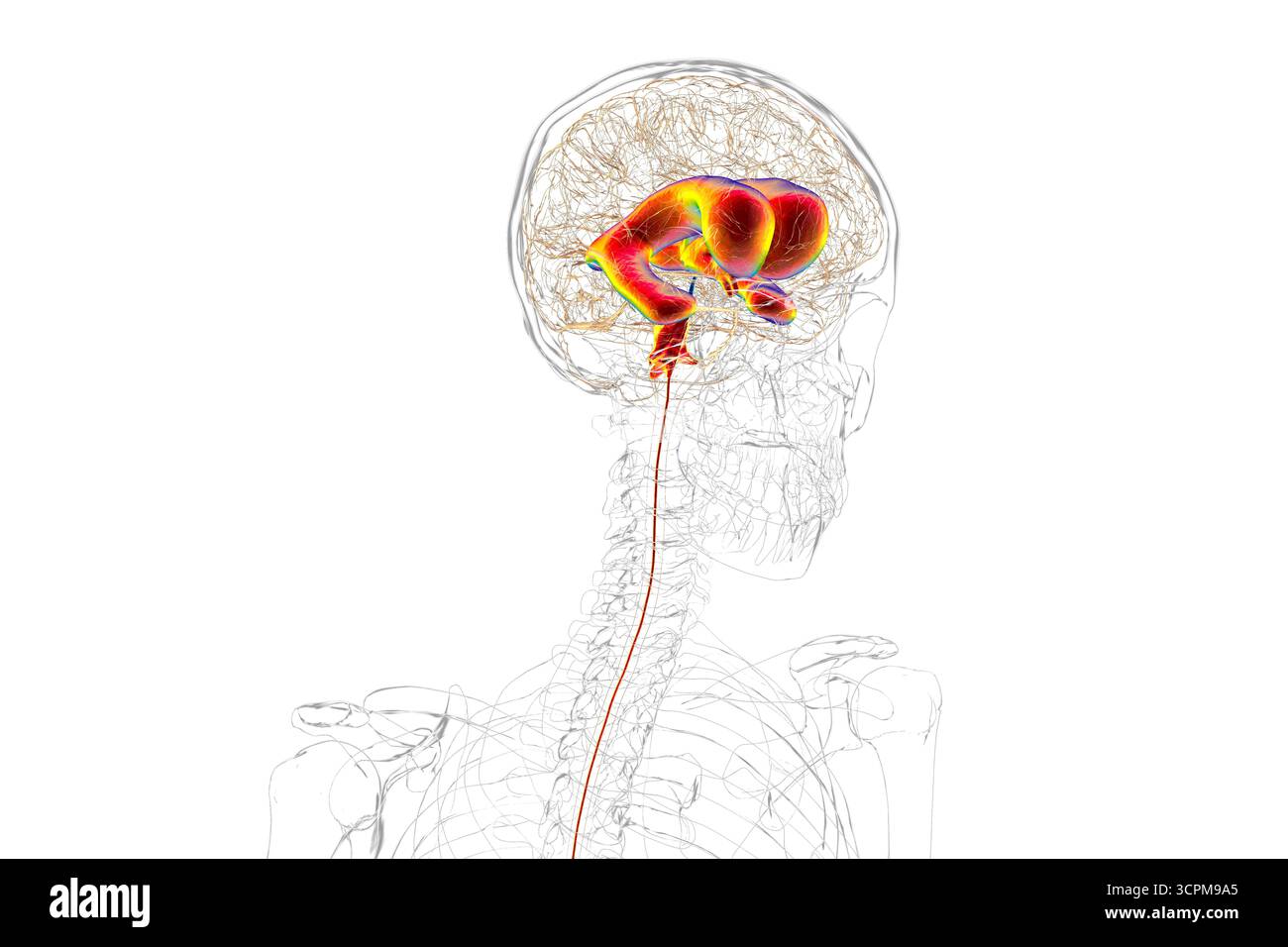 Human brain with normal pressure hydrocephalus, illustration showing ...