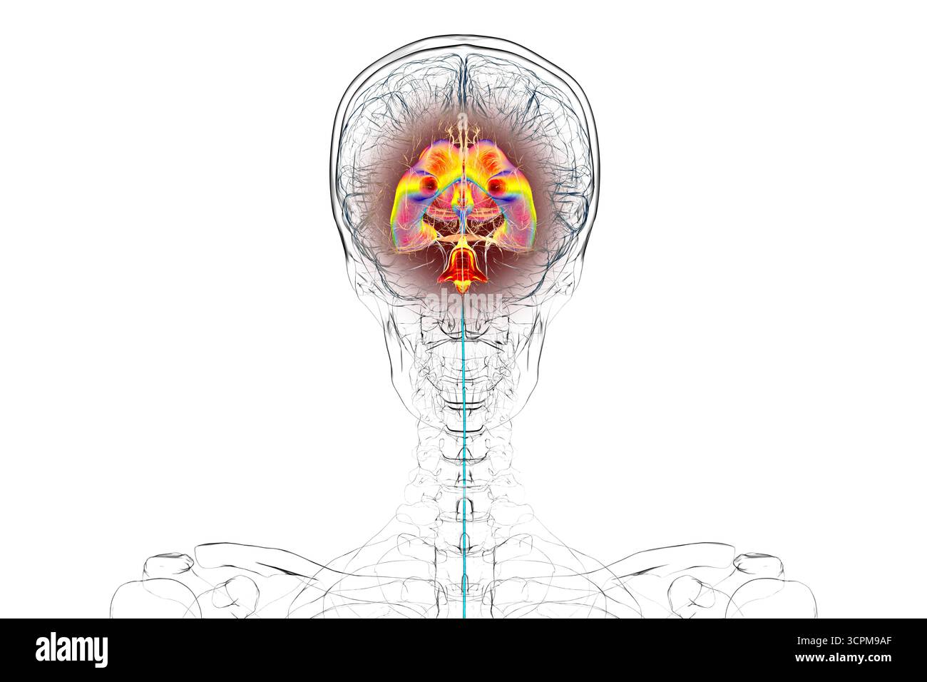 Human brain with normal pressure hydrocephalus, illustration showing ...
