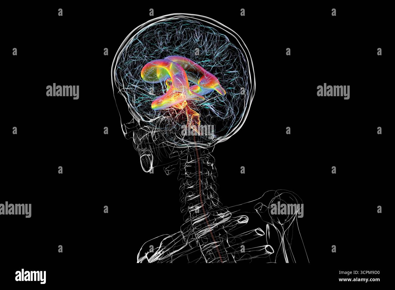 Illustration of enlarged lateral and third ventricles of the brain ...