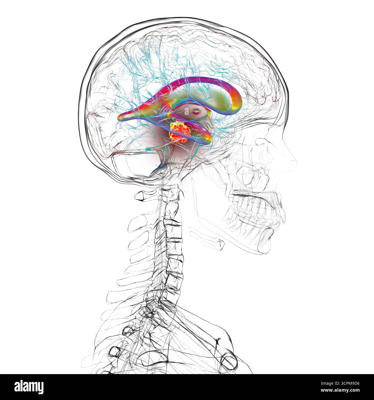 Illustration of enlarged lateral and third ventricles of the brain ...