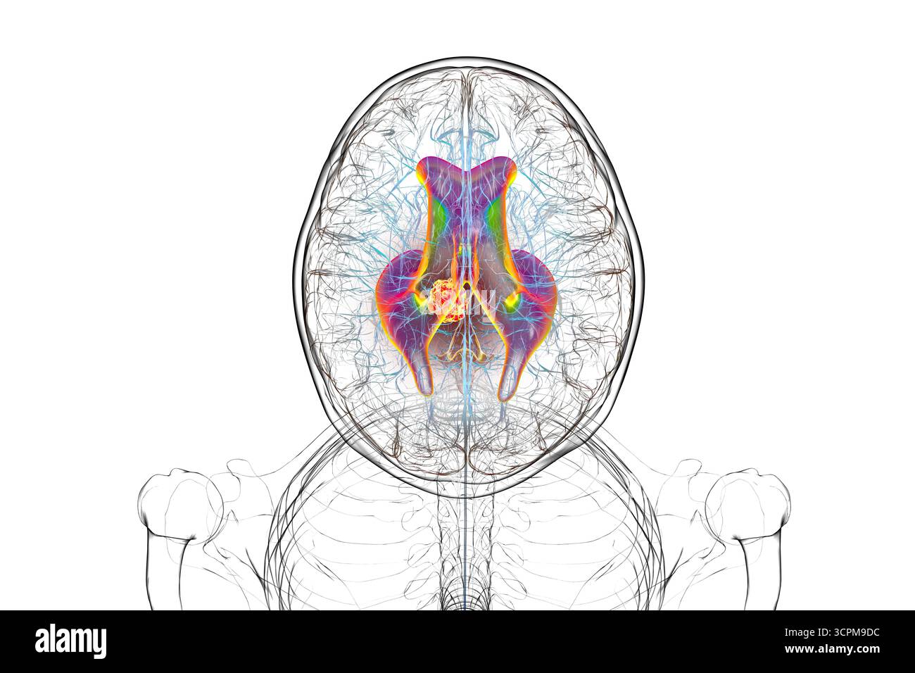 Illustration of enlarged lateral and third ventricles of the brain ...