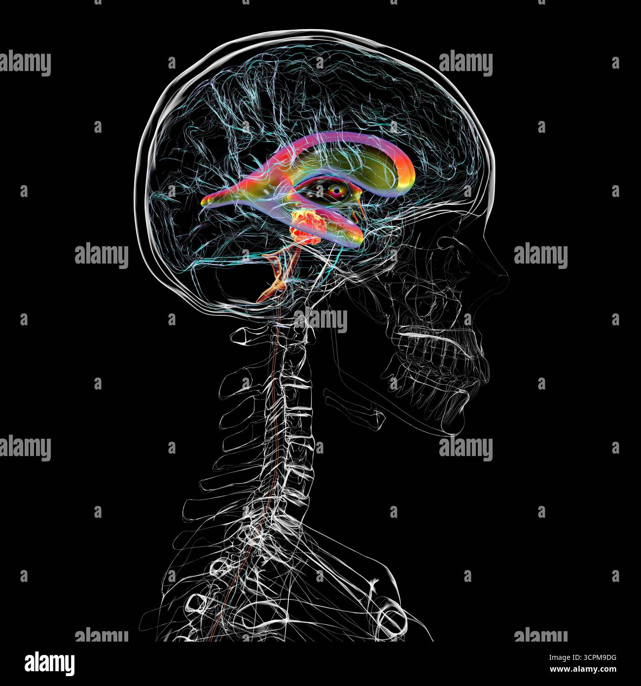 Illustration of enlarged lateral and third ventricles of the brain ...