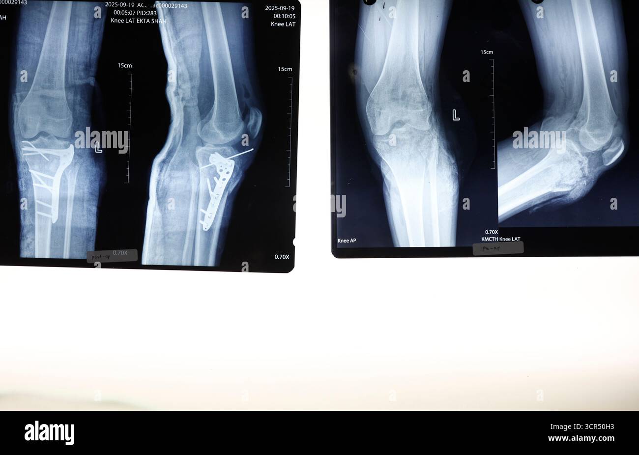 Kathmandu, Nepal. 30th Sep, 2025. An X-ray report showing metal plates ...