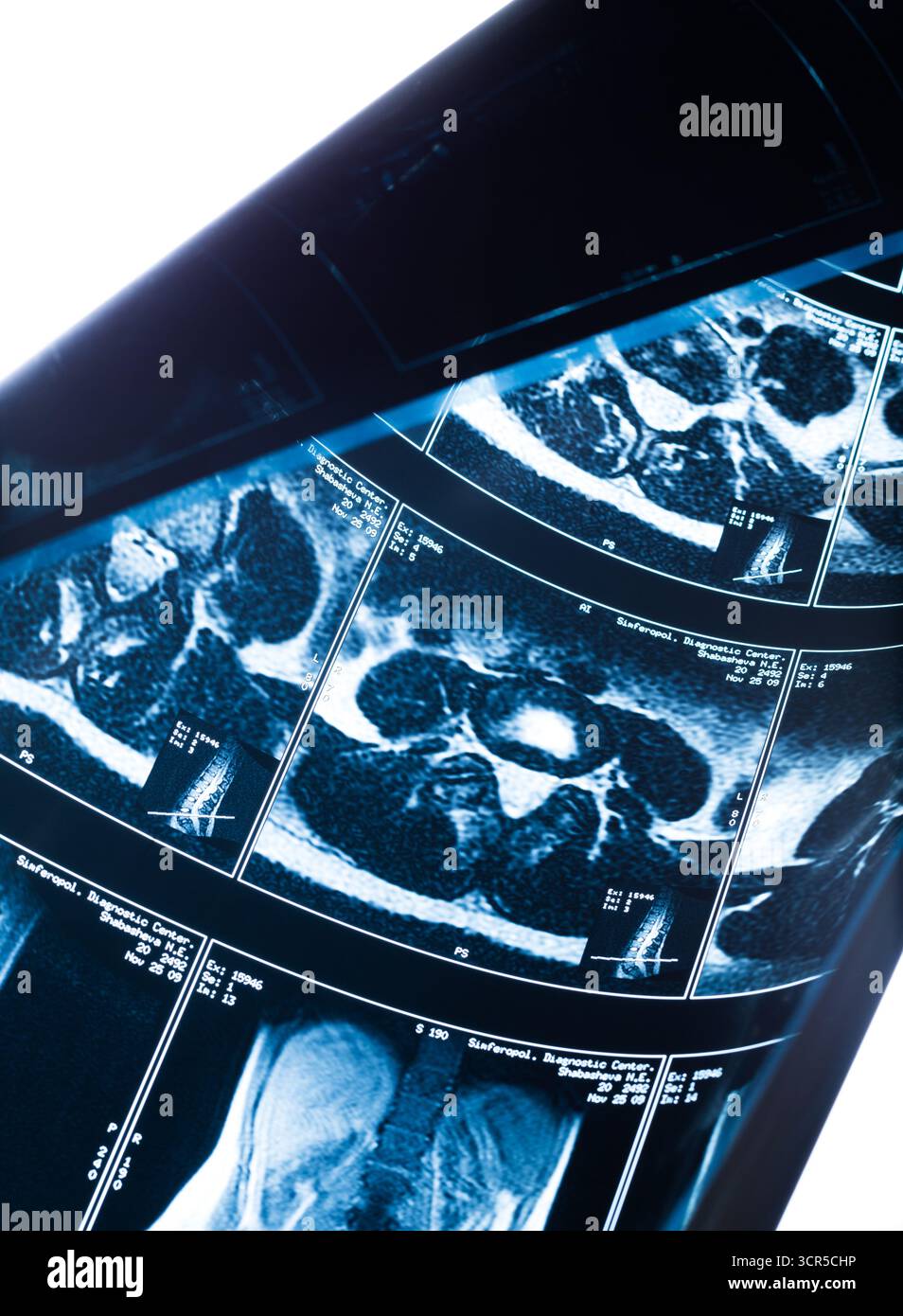 Medical imaging captures detailed views of spinal structure and ...