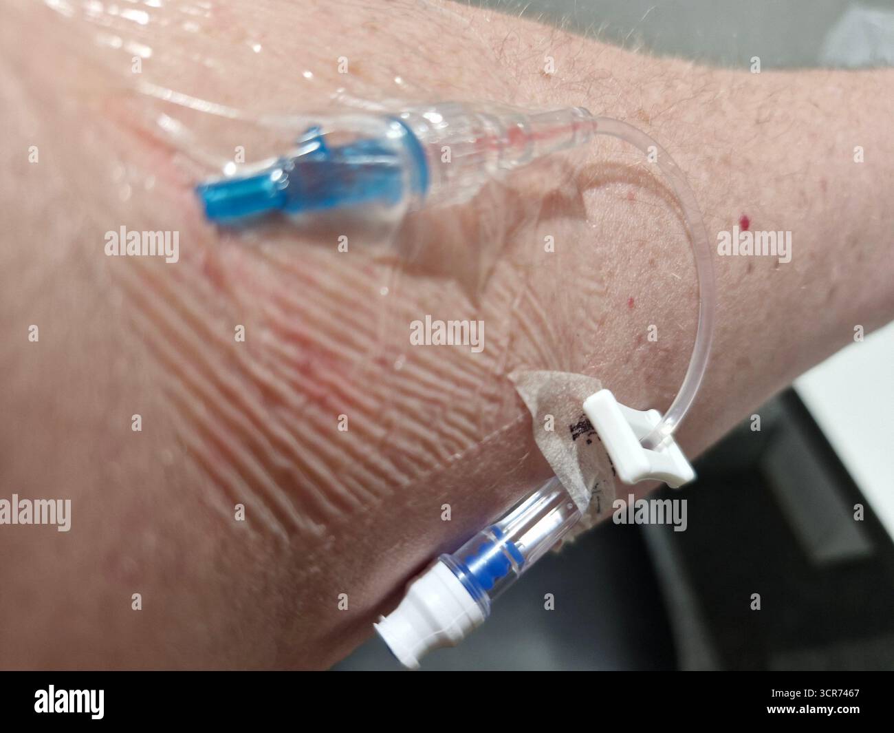 Cannula in arm hi-res stock photography and images - Alamy