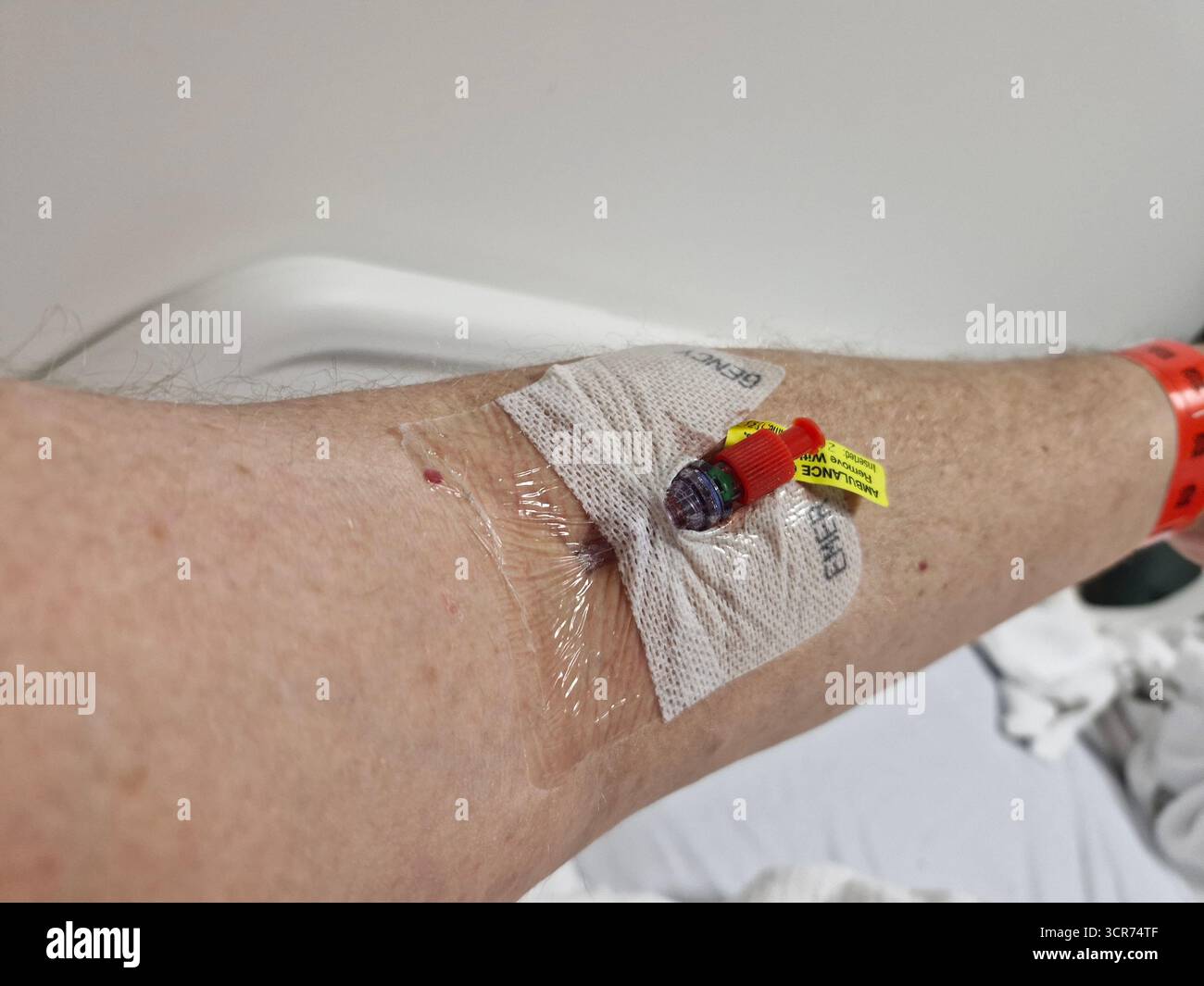 Cannula in arm hi-res stock photography and images - Alamy