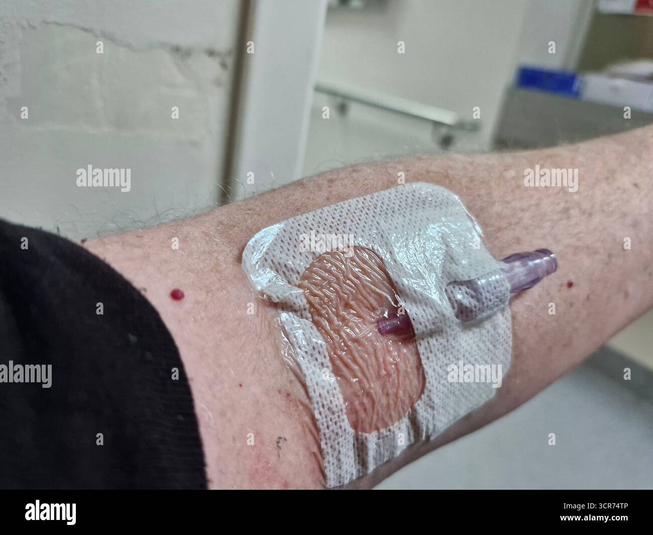 Cannula blood hi-res stock photography and images - Alamy
