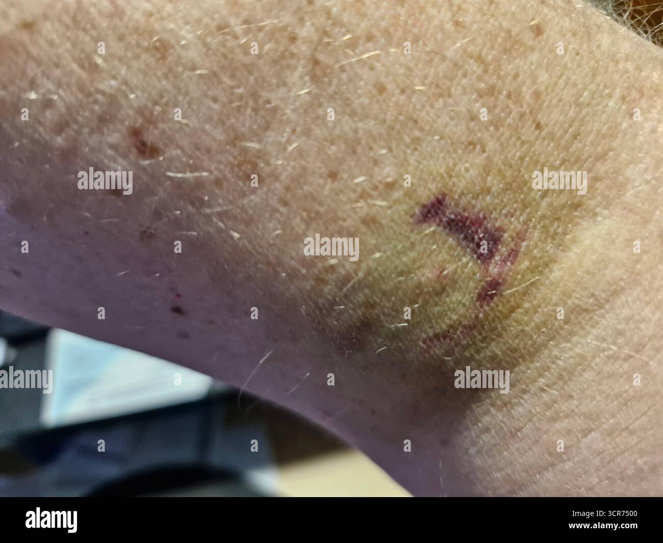 Cannula in arm hi-res stock photography and images - Alamy