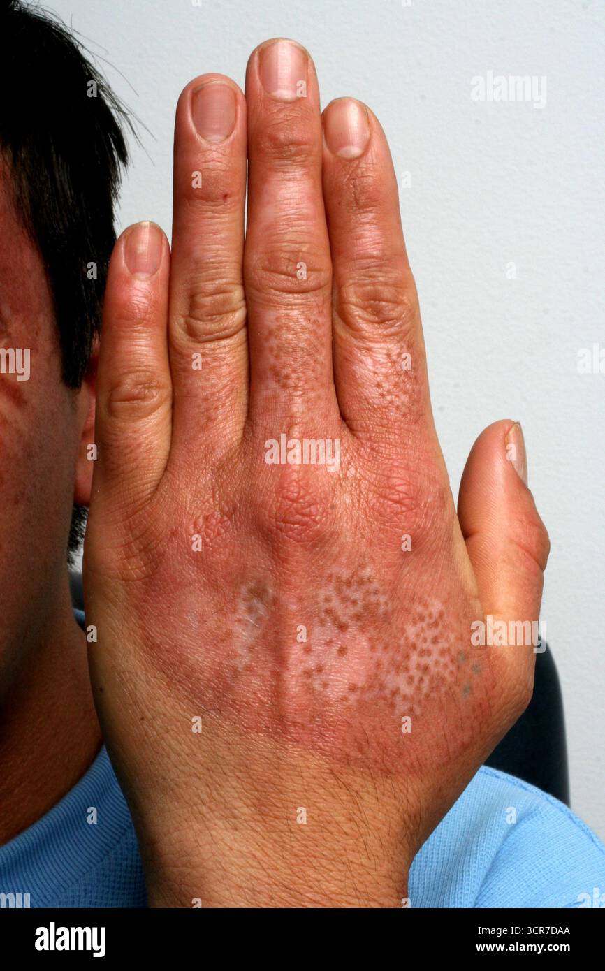 Hand burns - negligence case Stock Photo - Alamy