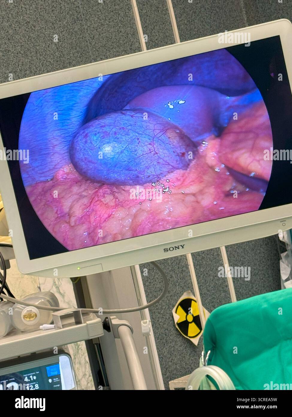 Laparoscopic view of hydrops of gallbladder. Hydrops of the gallbladder ...