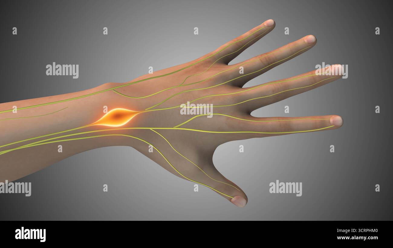 Nerve condition hi-res stock photography and images - Alamy