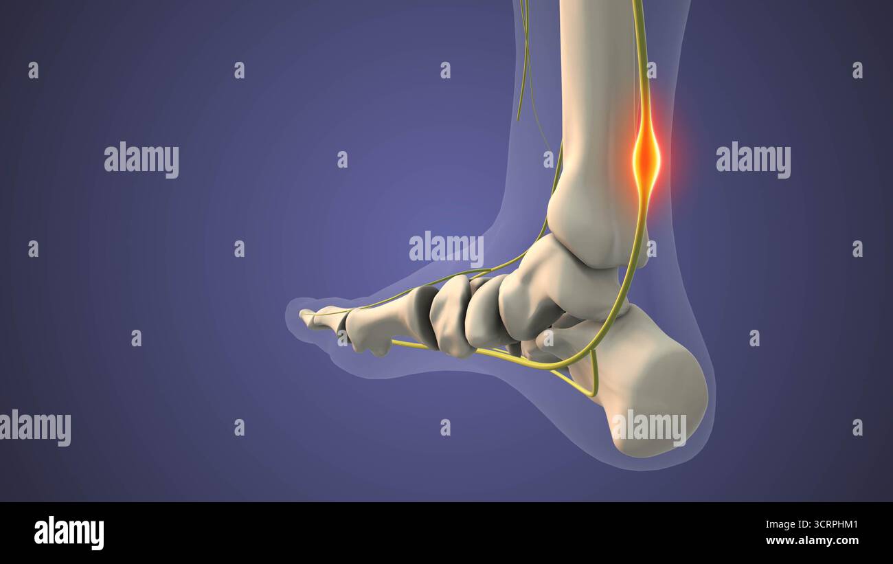 Peripheral Nerve Sheath Tumor in Foot Joint Stock Photo - Alamy