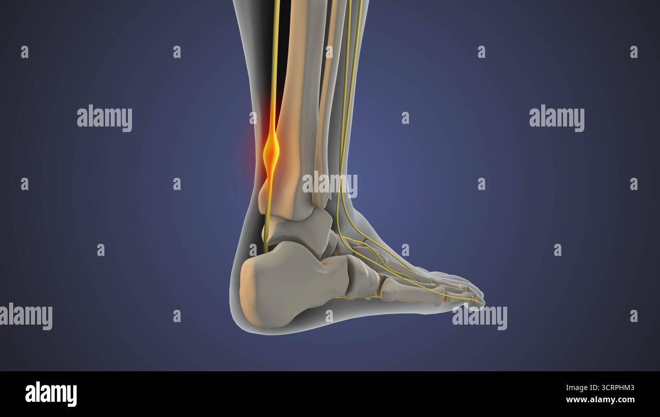 Peripheral Nerve Tumor in Foot Joint Stock Photo - Alamy