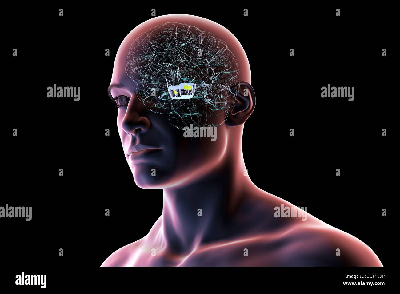 Illustration of a human brain with degenerated substantia nigra in ...