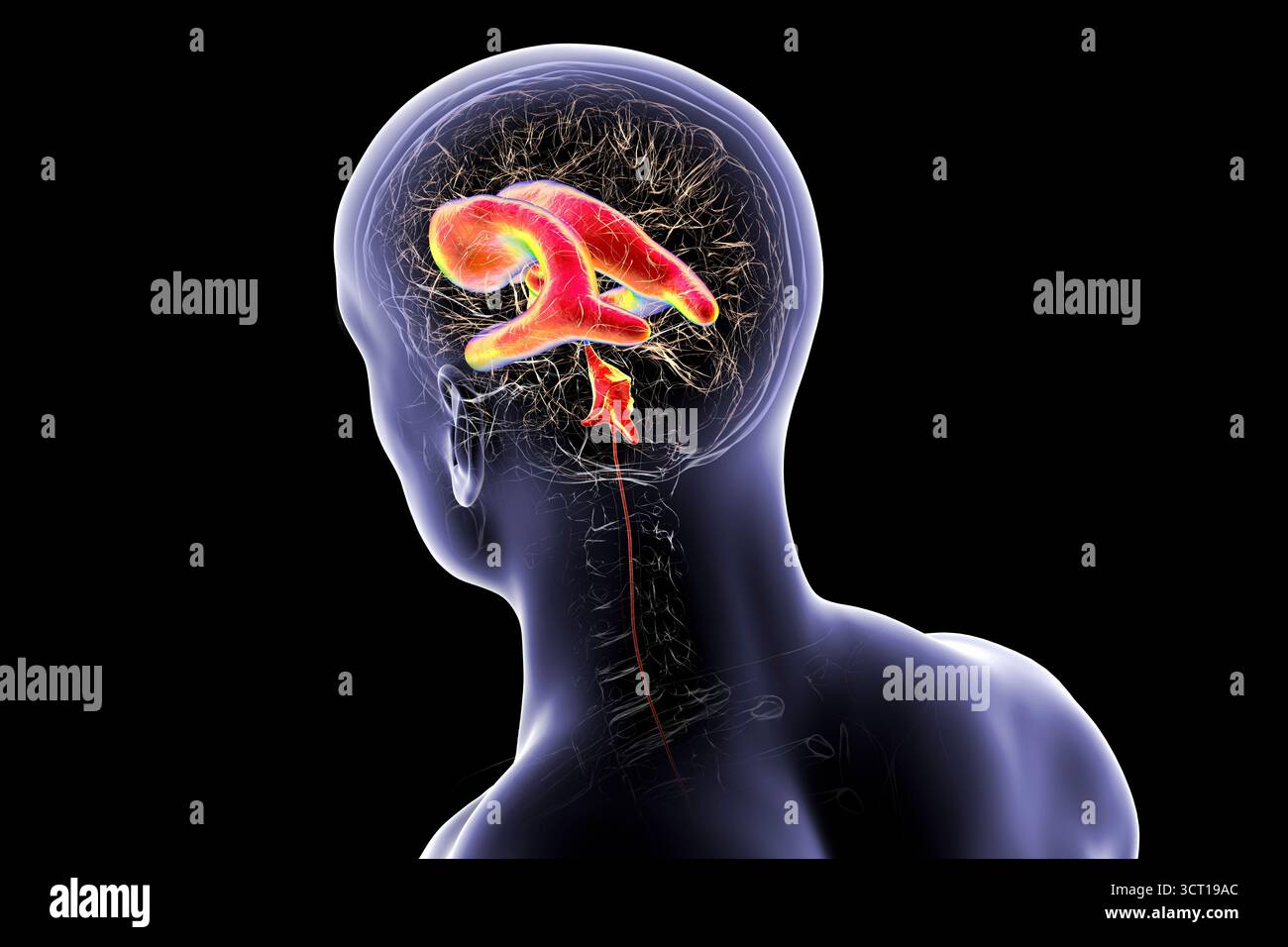 Illustration of a human brain with normal pressure hydrocephalus. This ...