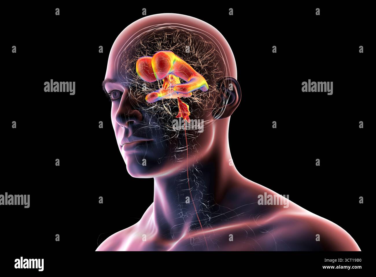 Illustration of a human brain with normal pressure hydrocephalus. This ...