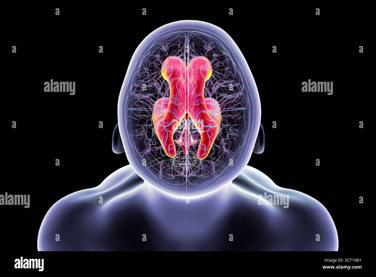 Illustration Of A Human Brain With Normal Pressure Hydrocephalus. This 
