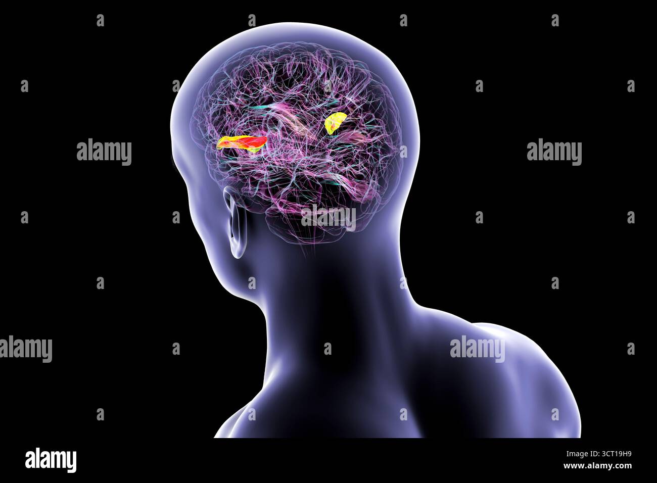 Illustration of the human brain with the transverse temporal gyri ...