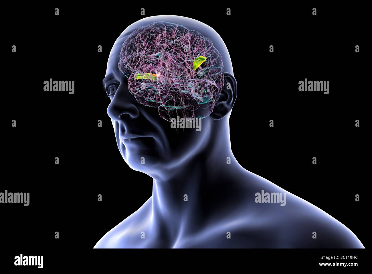 Illustration of the human brain with the transverse temporal gyri ...