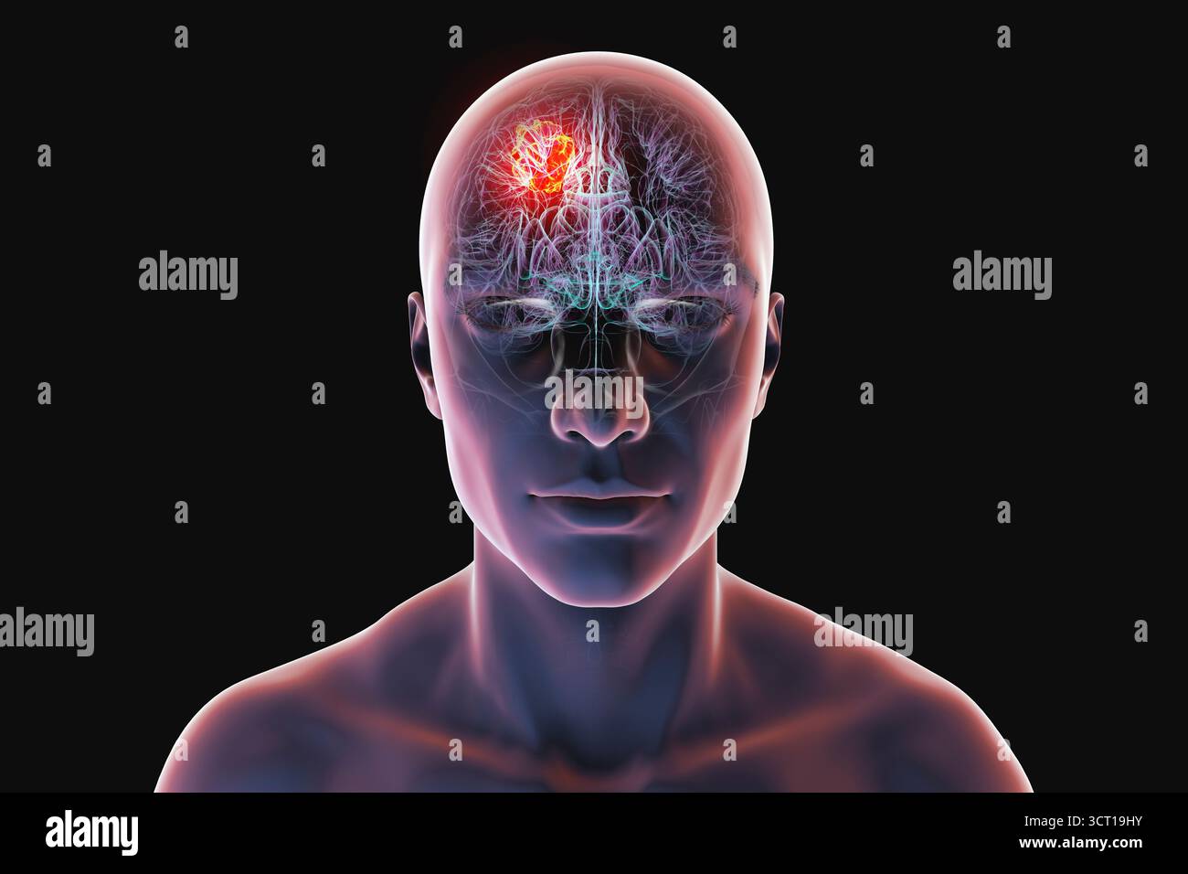Illustration of a brain tumour. A brain tumour is a mass of abnormal ...