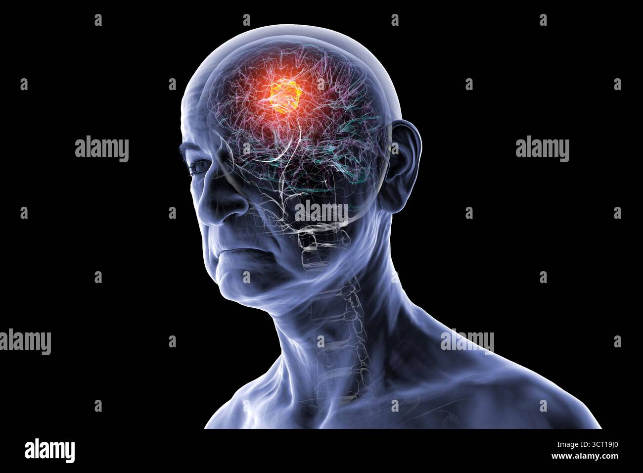 Illustration of a brain tumour in a senior person. A brain tumour is a ...