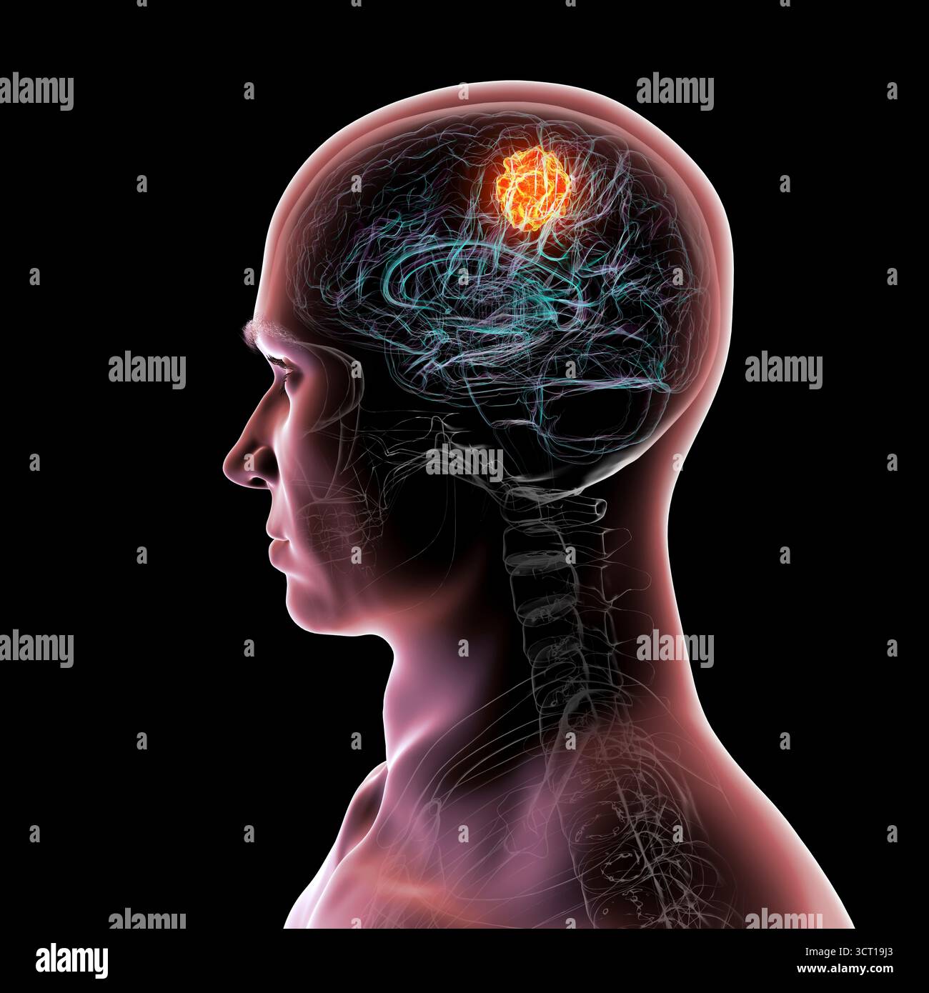 Illustration of a brain tumour. A brain tumour is a mass of abnormal ...