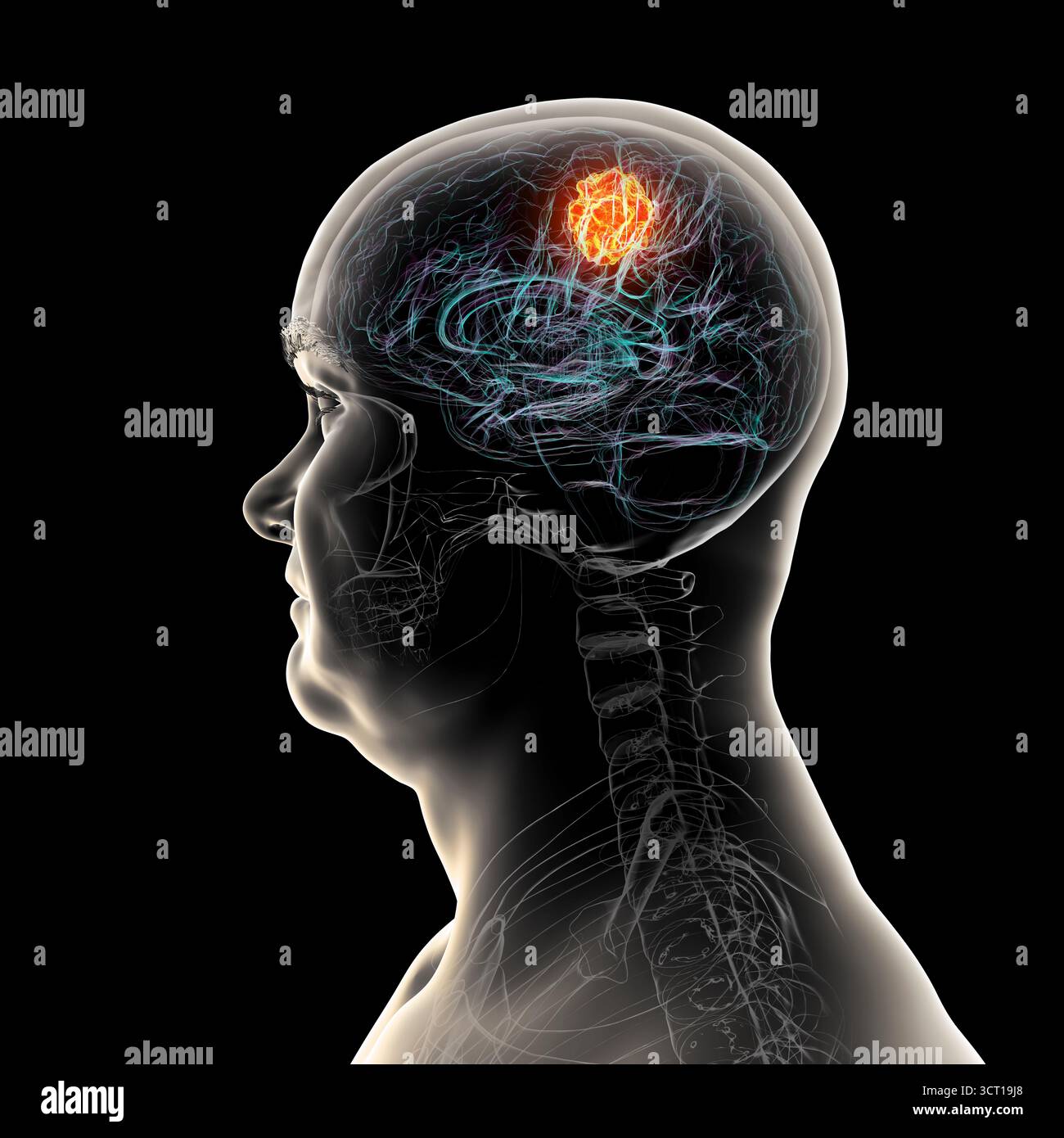 Illustration of a brain tumour. A brain tumour is a mass of abnormal ...