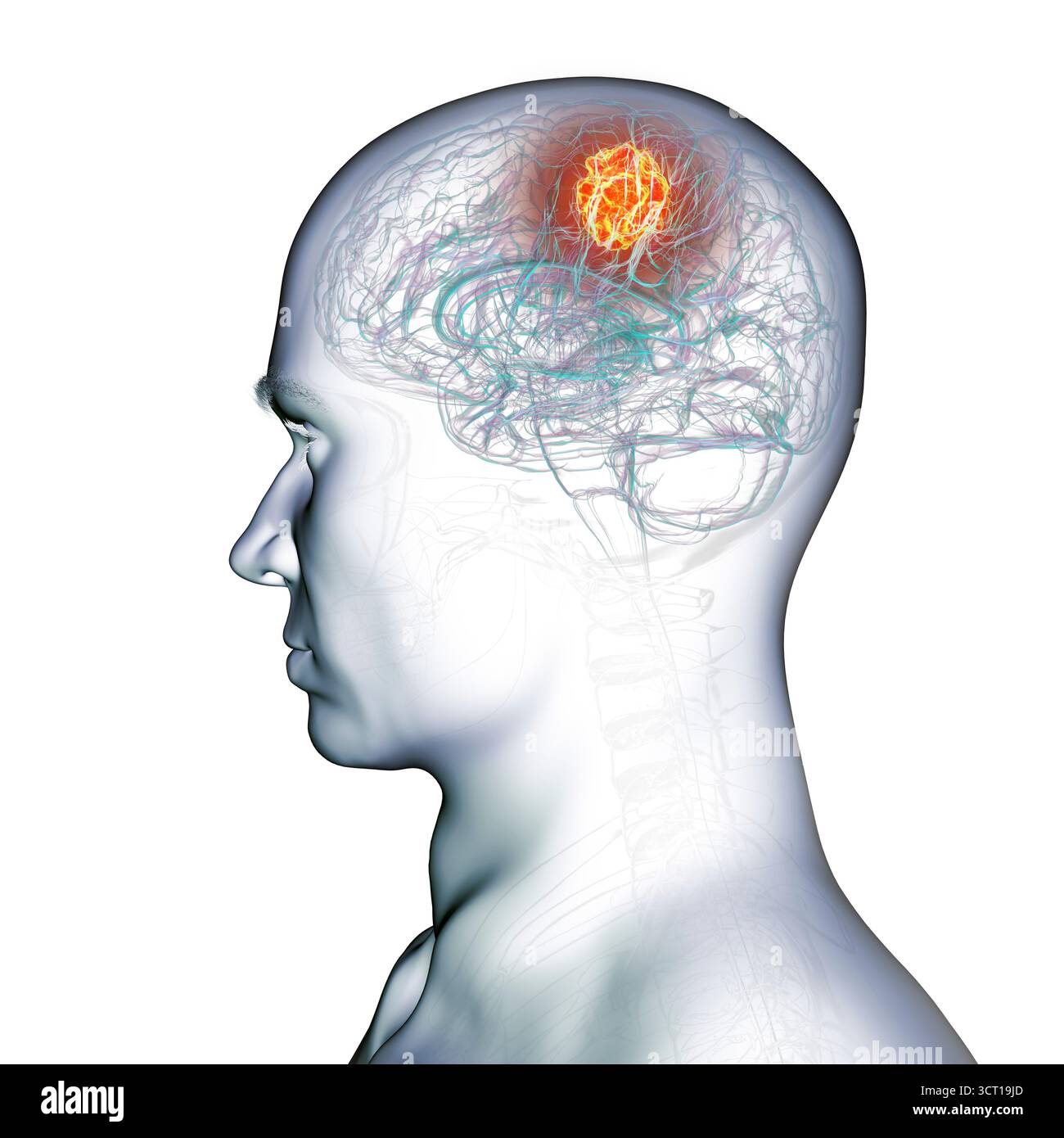 Illustration of a brain tumour. A brain tumour is a mass of abnormal ...