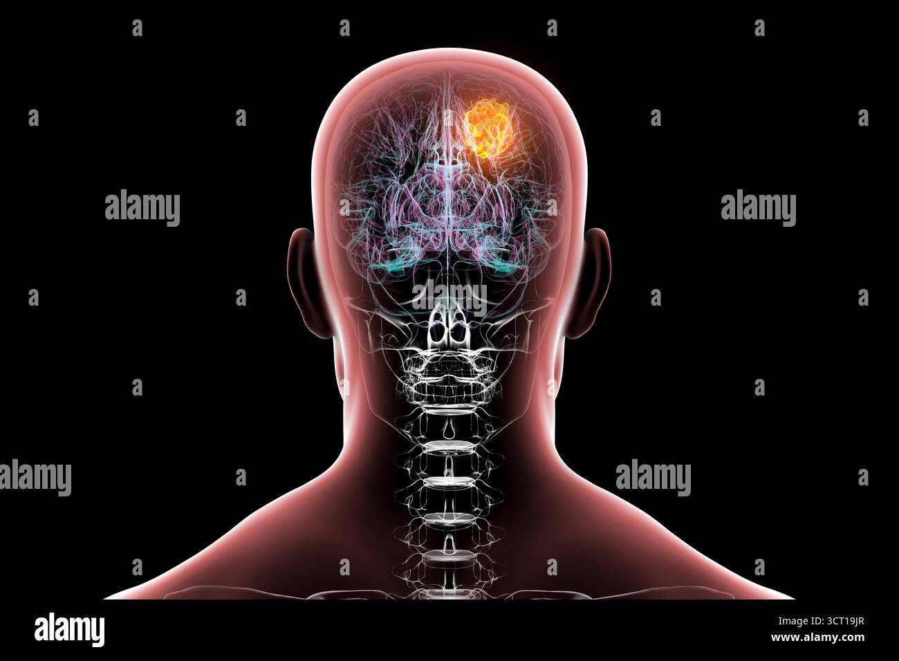 Illustration of a brain tumour. A brain tumour is a mass of abnormal ...
