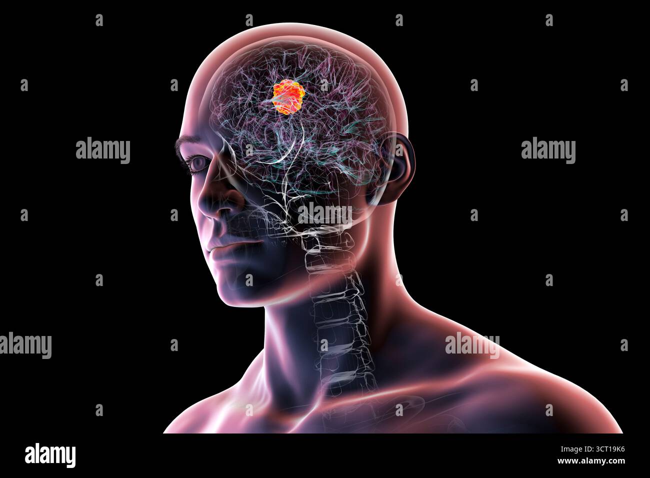 Illustration of a brain tumour. A brain tumour is a mass of abnormal ...