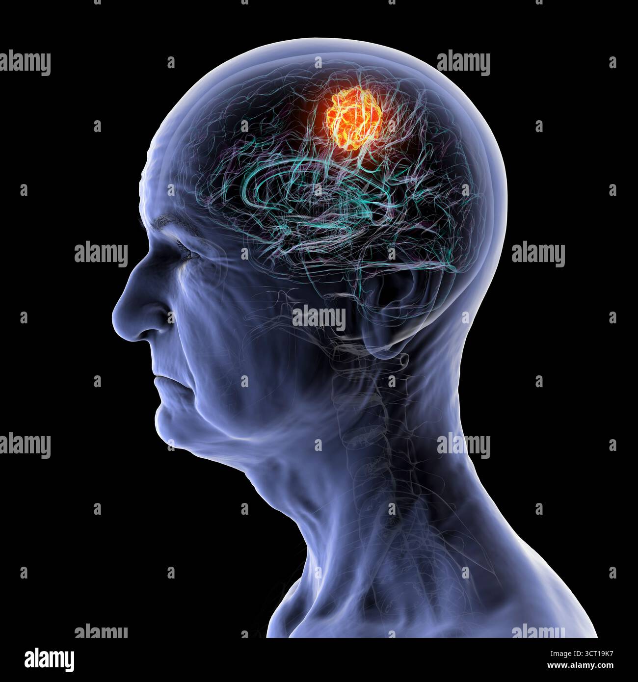 Illustration of a brain tumour in a senior person. A brain tumour is a ...