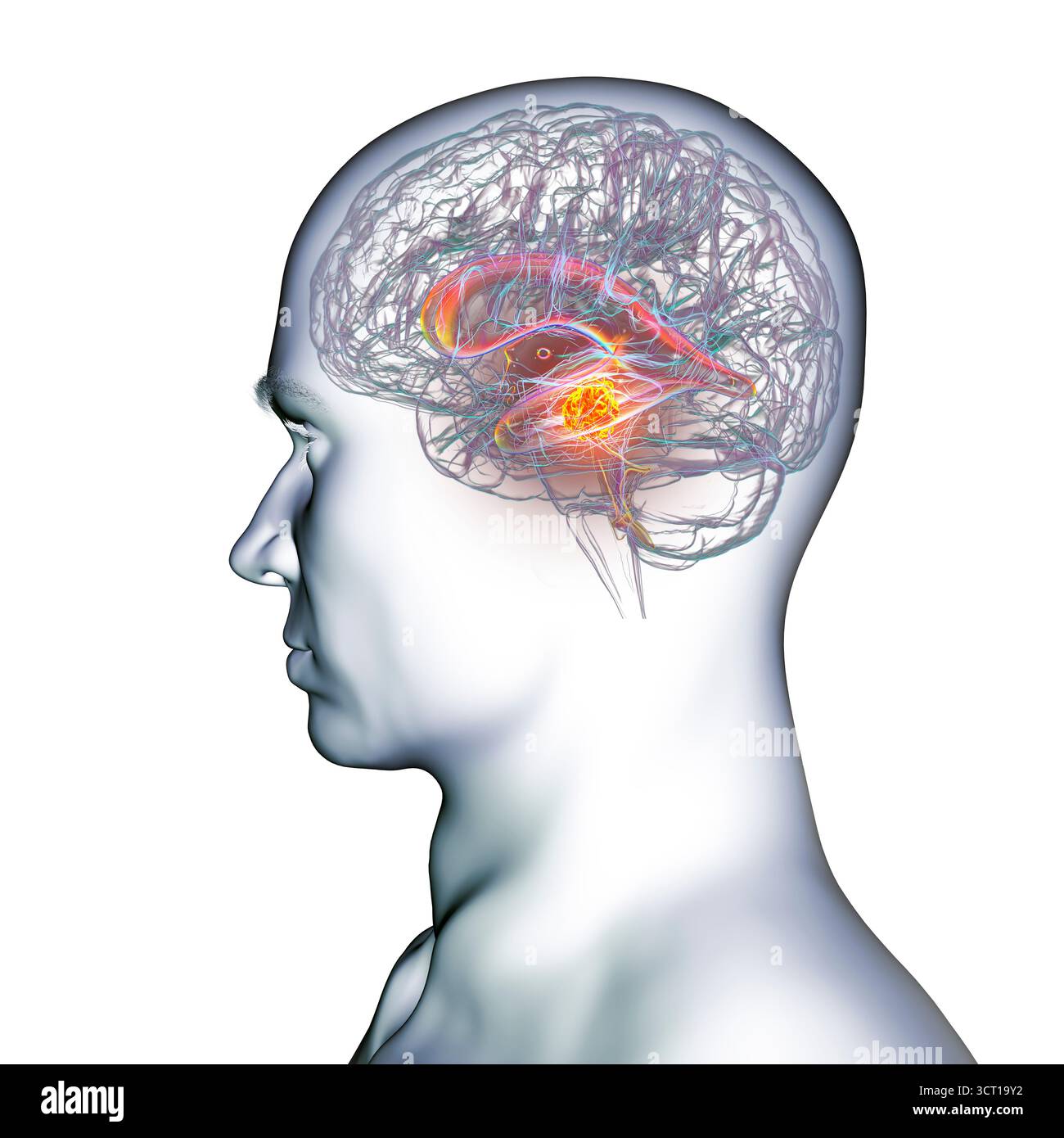 Illustration of enlarged lateral and third ventricles of the brain ...