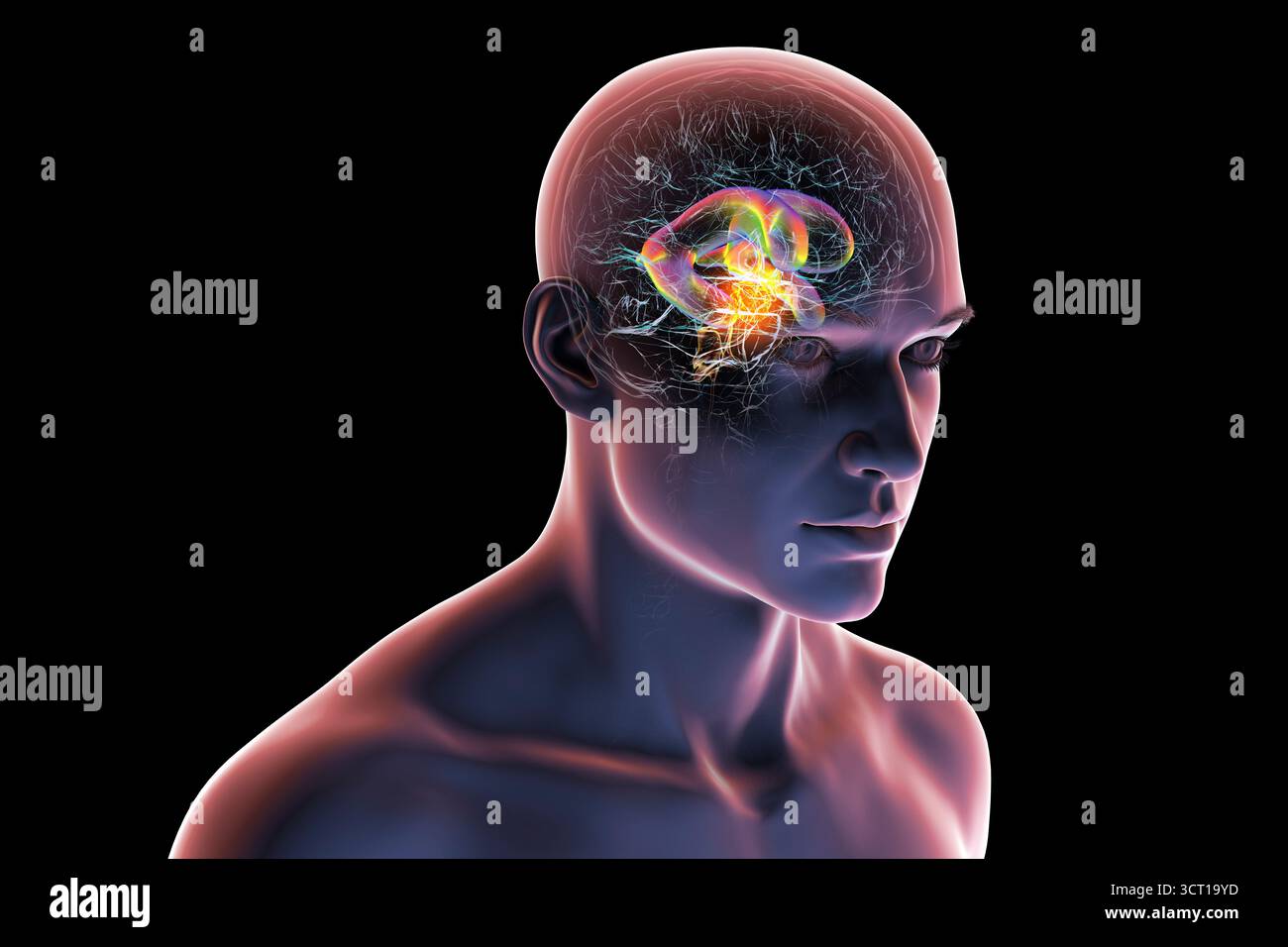 Illustration of enlarged lateral and third ventricles of the brain ...