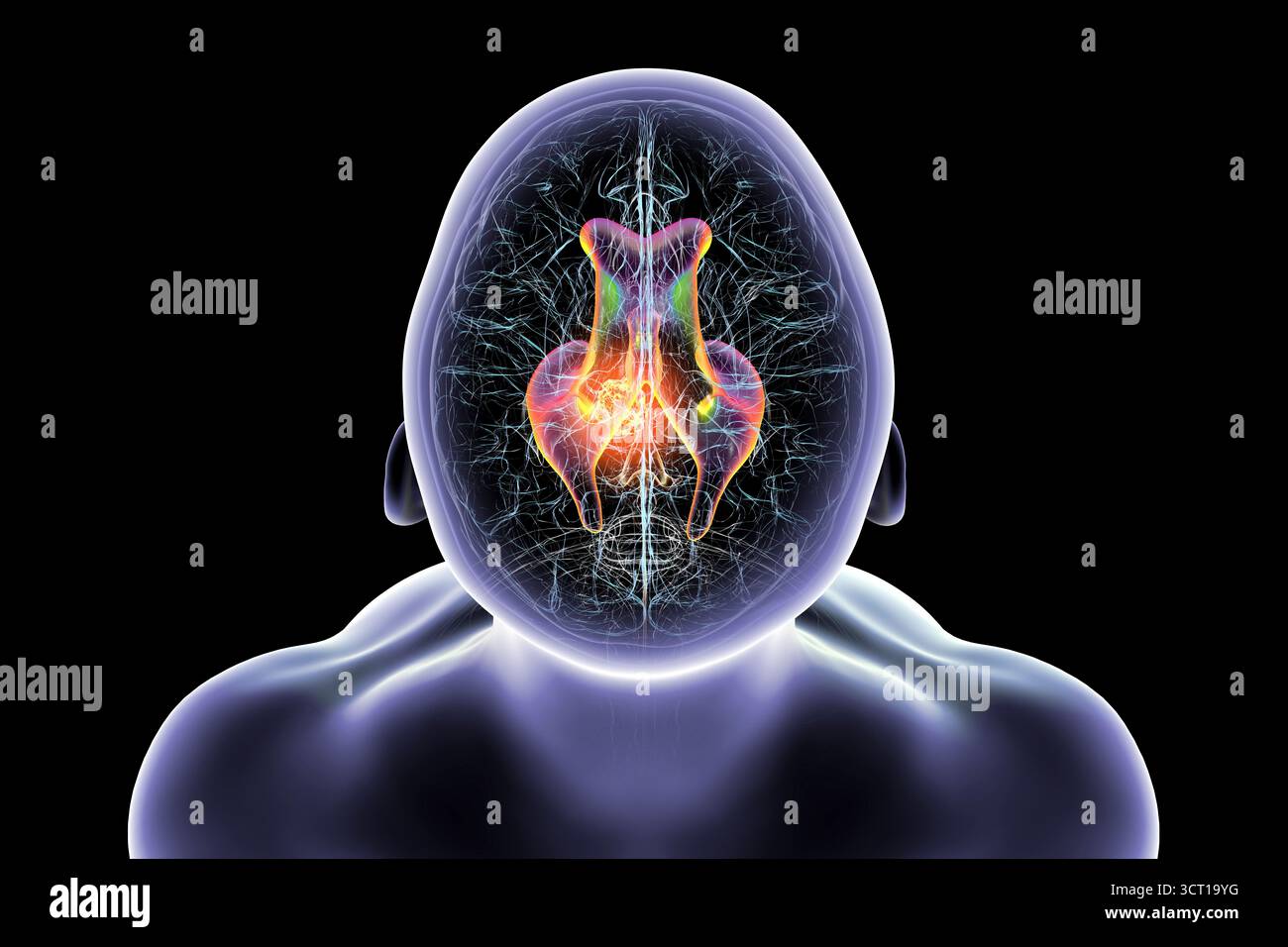 Illustration of enlarged lateral and third ventricles of the brain ...