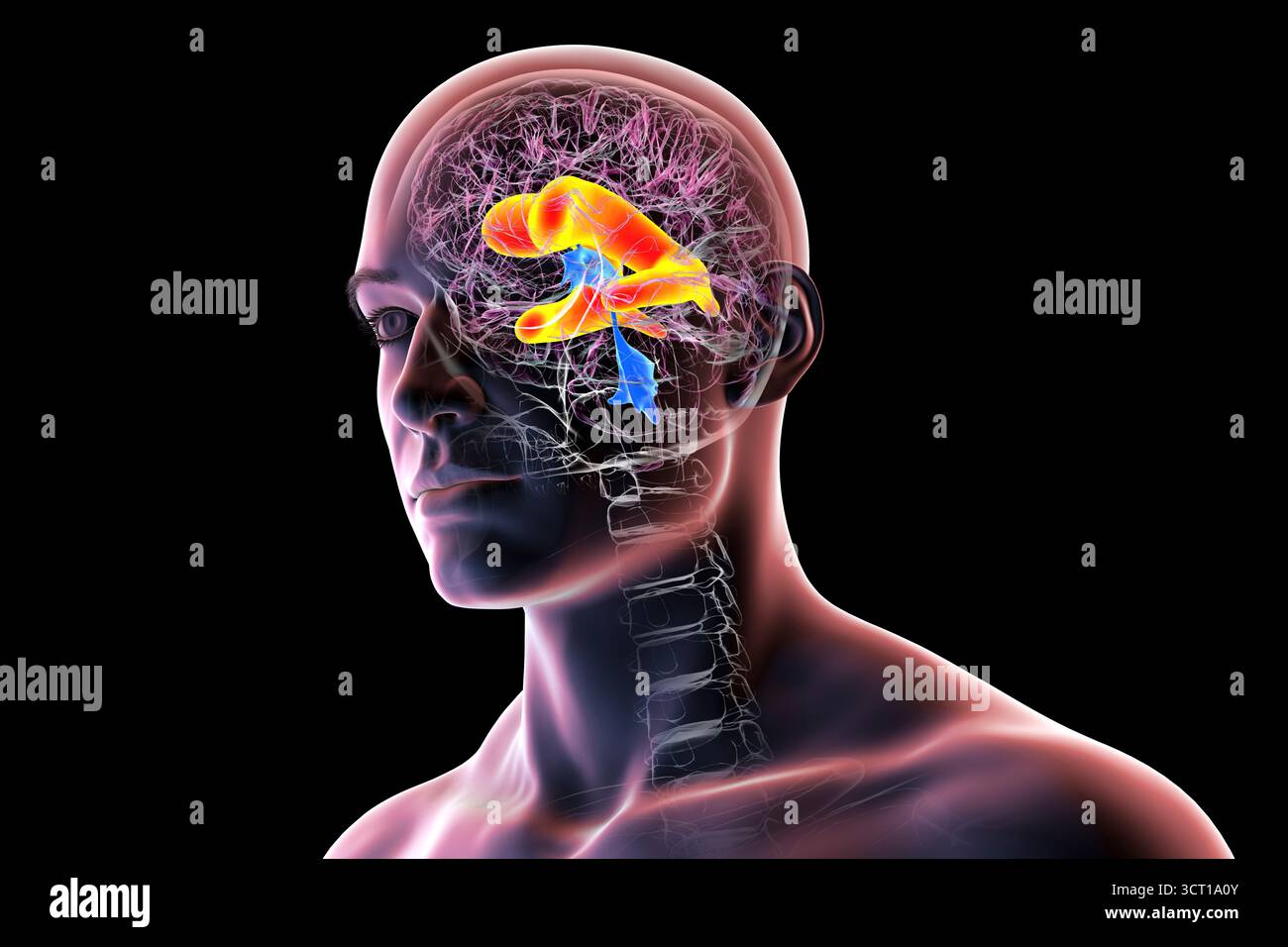 Illustration of enlarged lateral ventricles of the brain (hydrocephalus ...