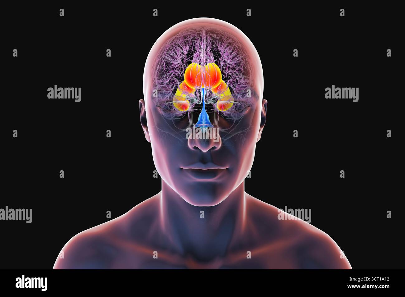 Illustration of enlarged lateral ventricles of the brain (hydrocephalus ...