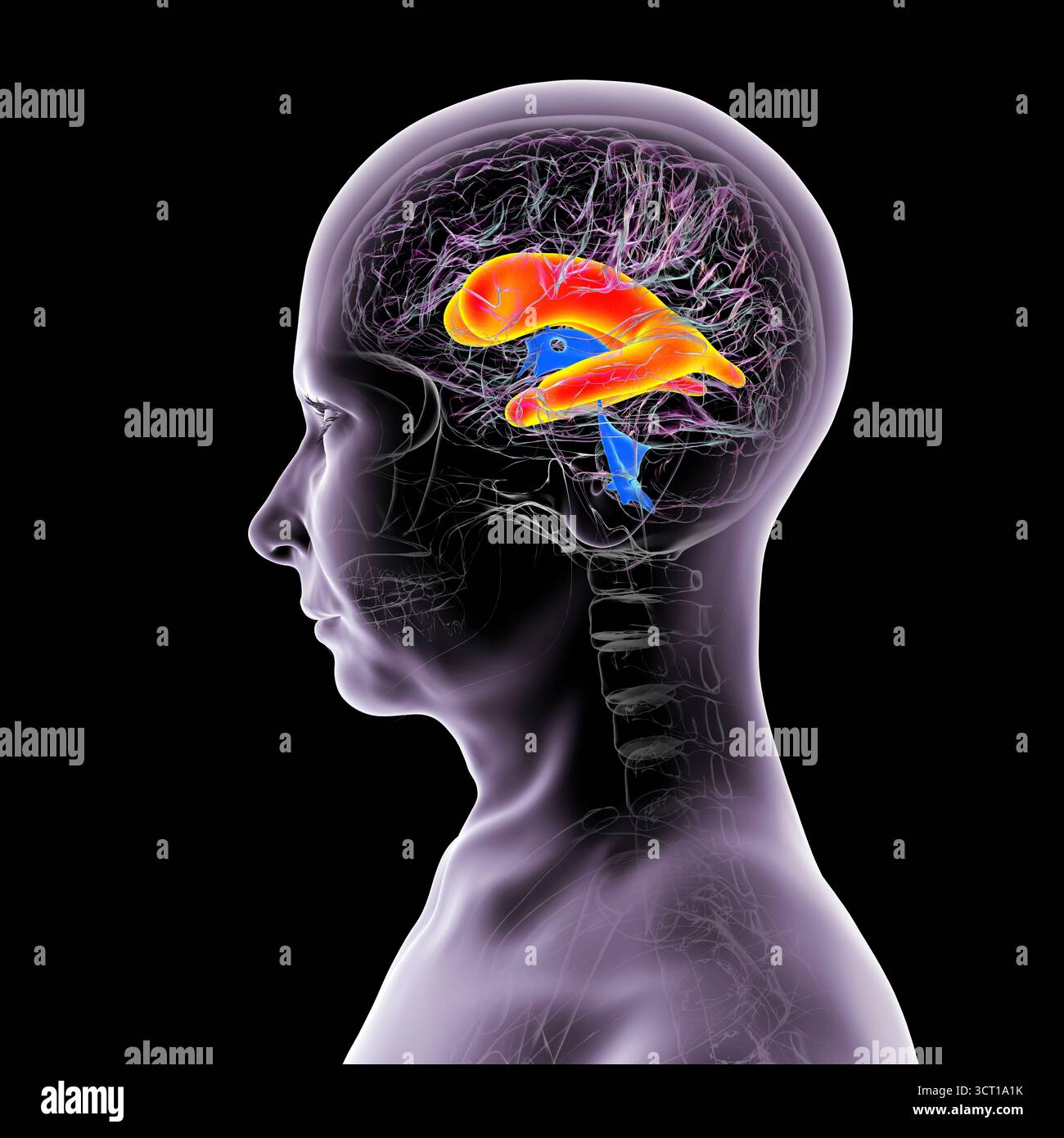Illustration of enlarged lateral ventricles of the brain (hydrocephalus ...