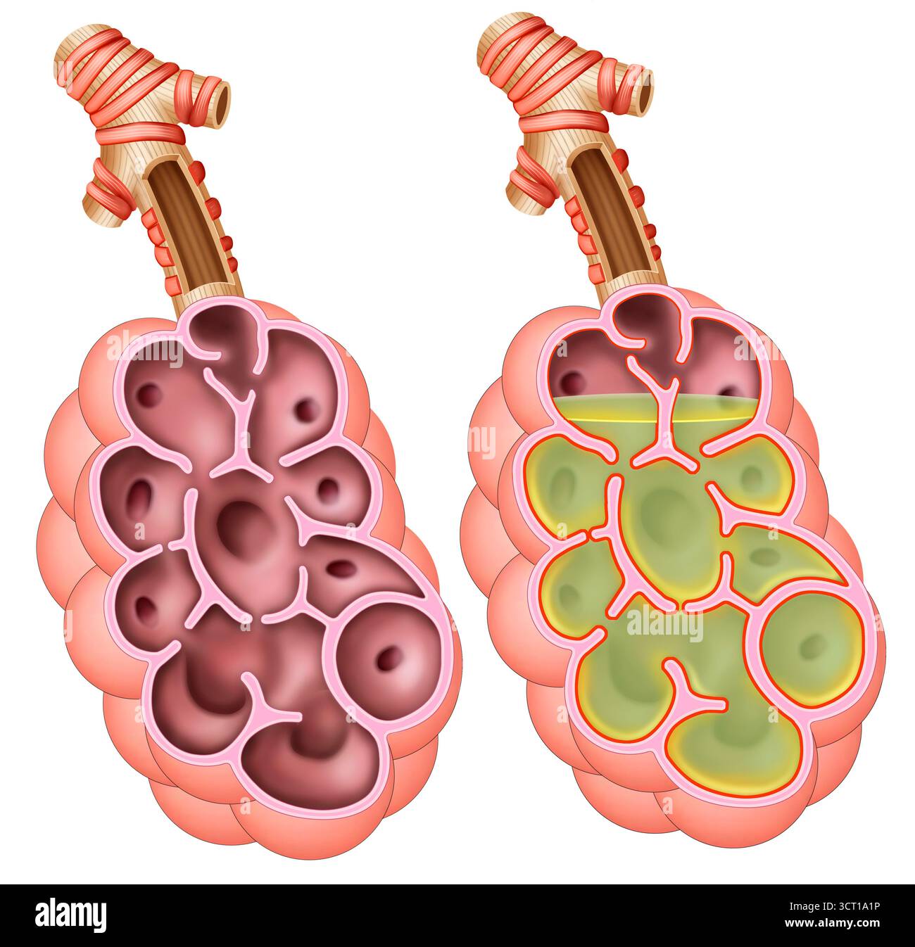Illustration of two alveoli, one healthy and one affected by pneumonia ...
