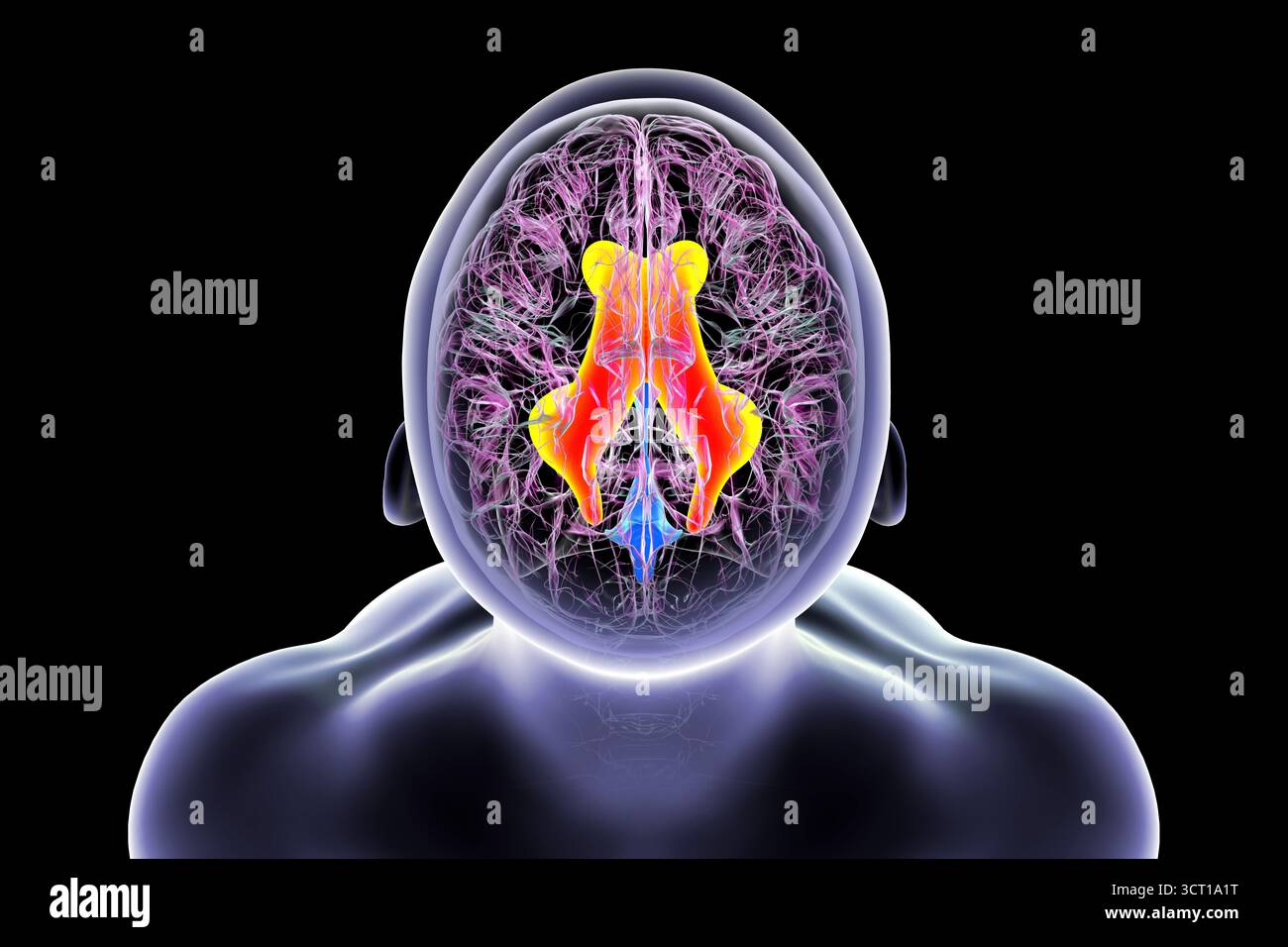 Illustration of enlarged lateral ventricles of the brain (hydrocephalus ...
